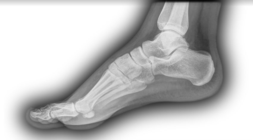 Tarsal boss: een pijnlijke verdikking op de wreef • BeautyWeb
